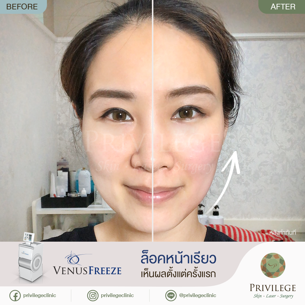 Venus Freeze Face - Privilege Clinic