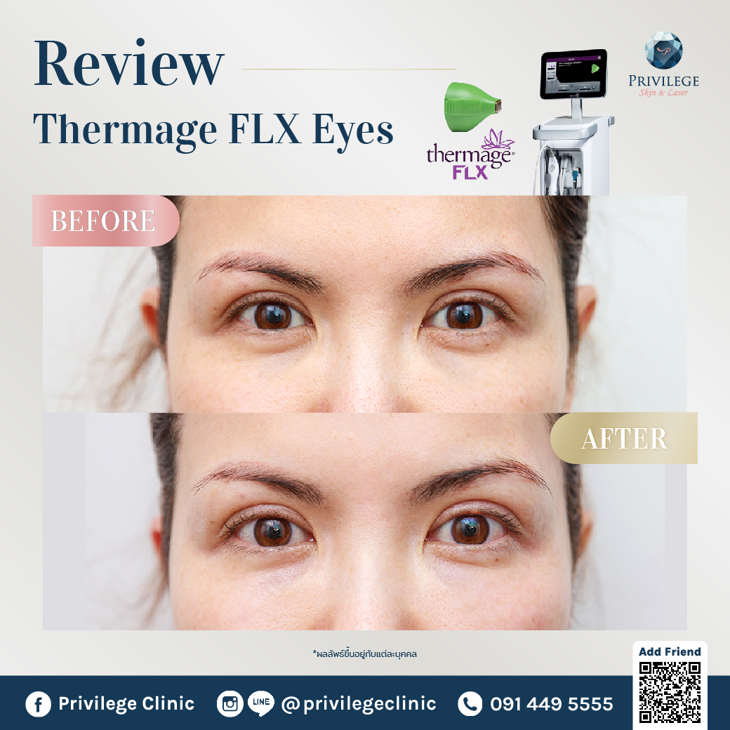 Thermage Eyes - Privilege Clinic