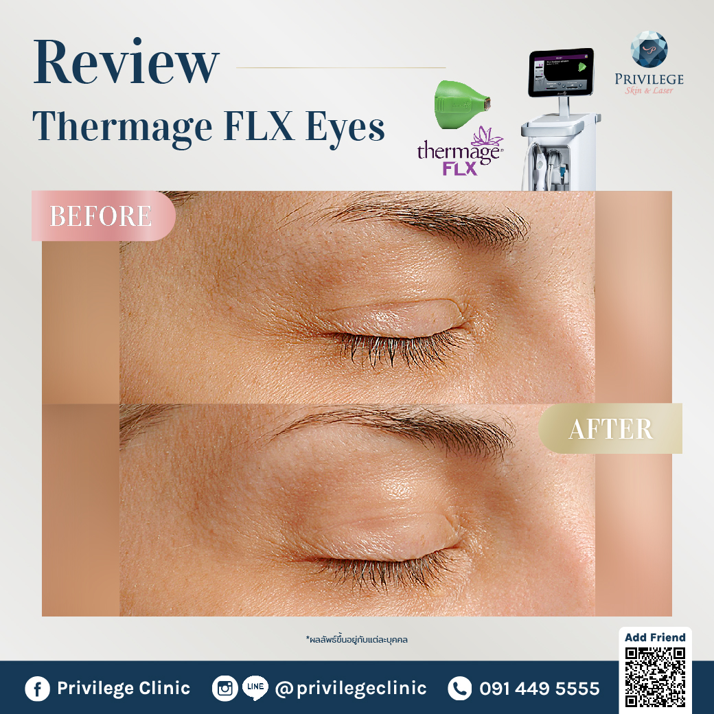 Thermage Eyes - Privilege Clinic