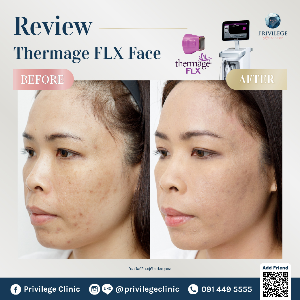 Thermage - Privilege Clinic