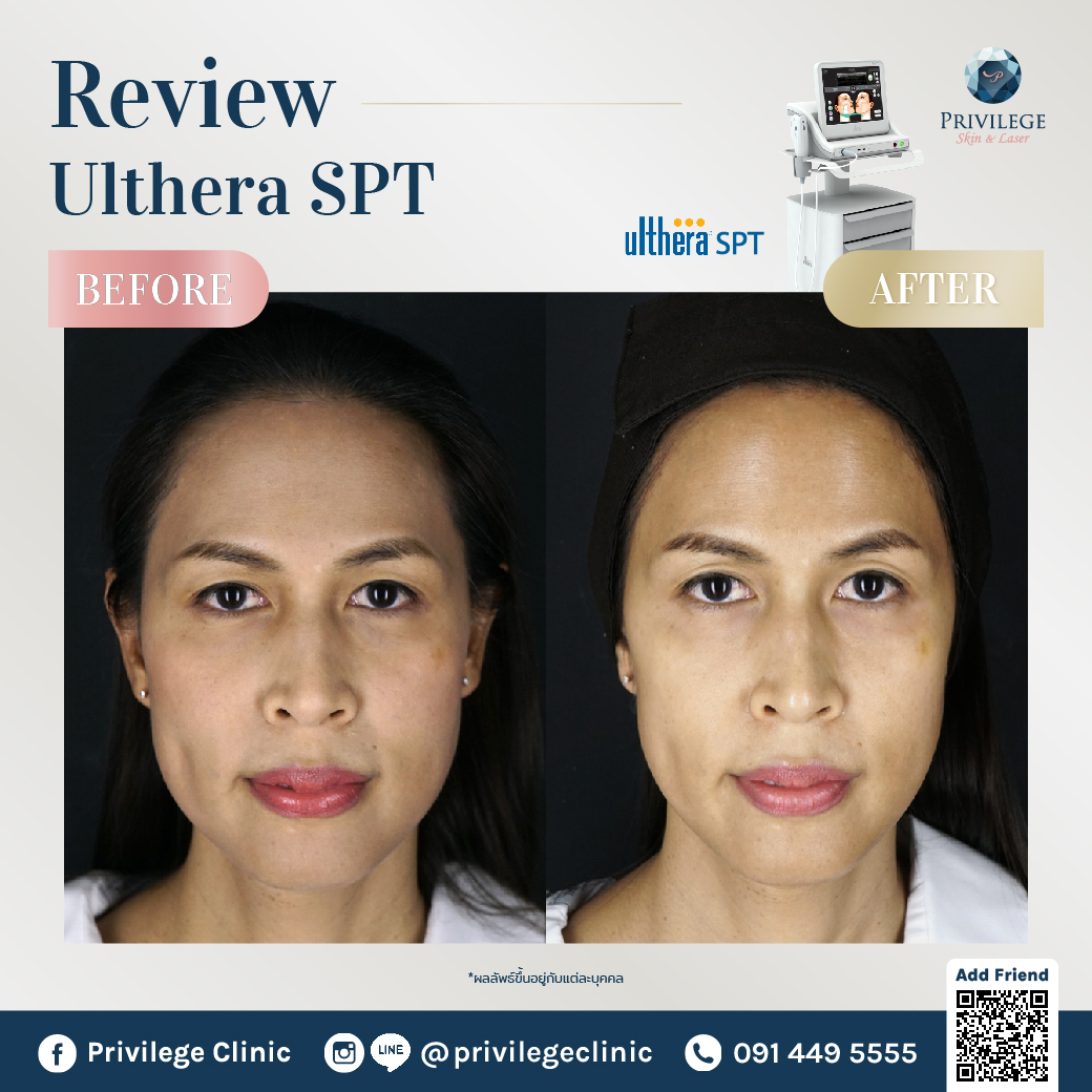 Ulthera – Privilege Clinic