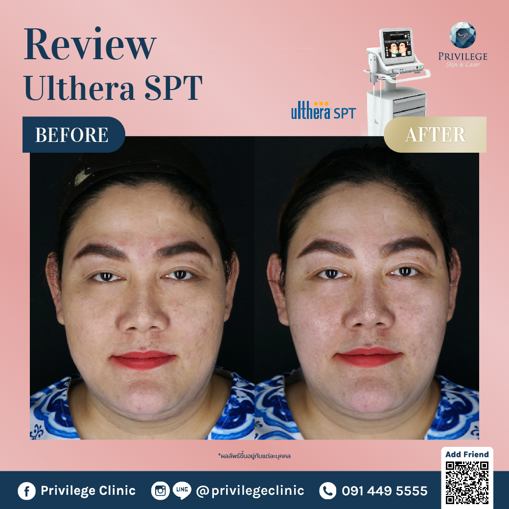 Ulthera - Privilege Clinic