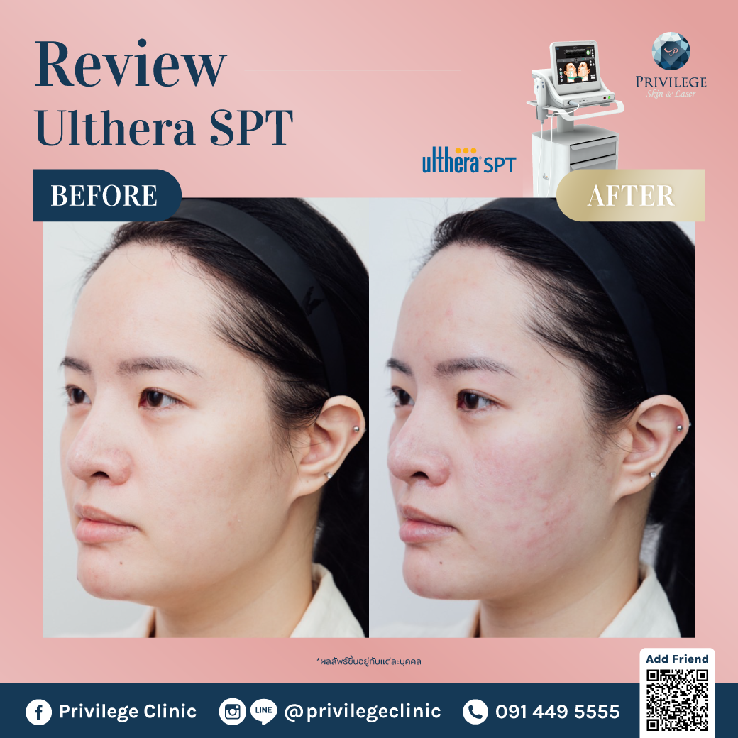 Ulthera - Privilege Clinic