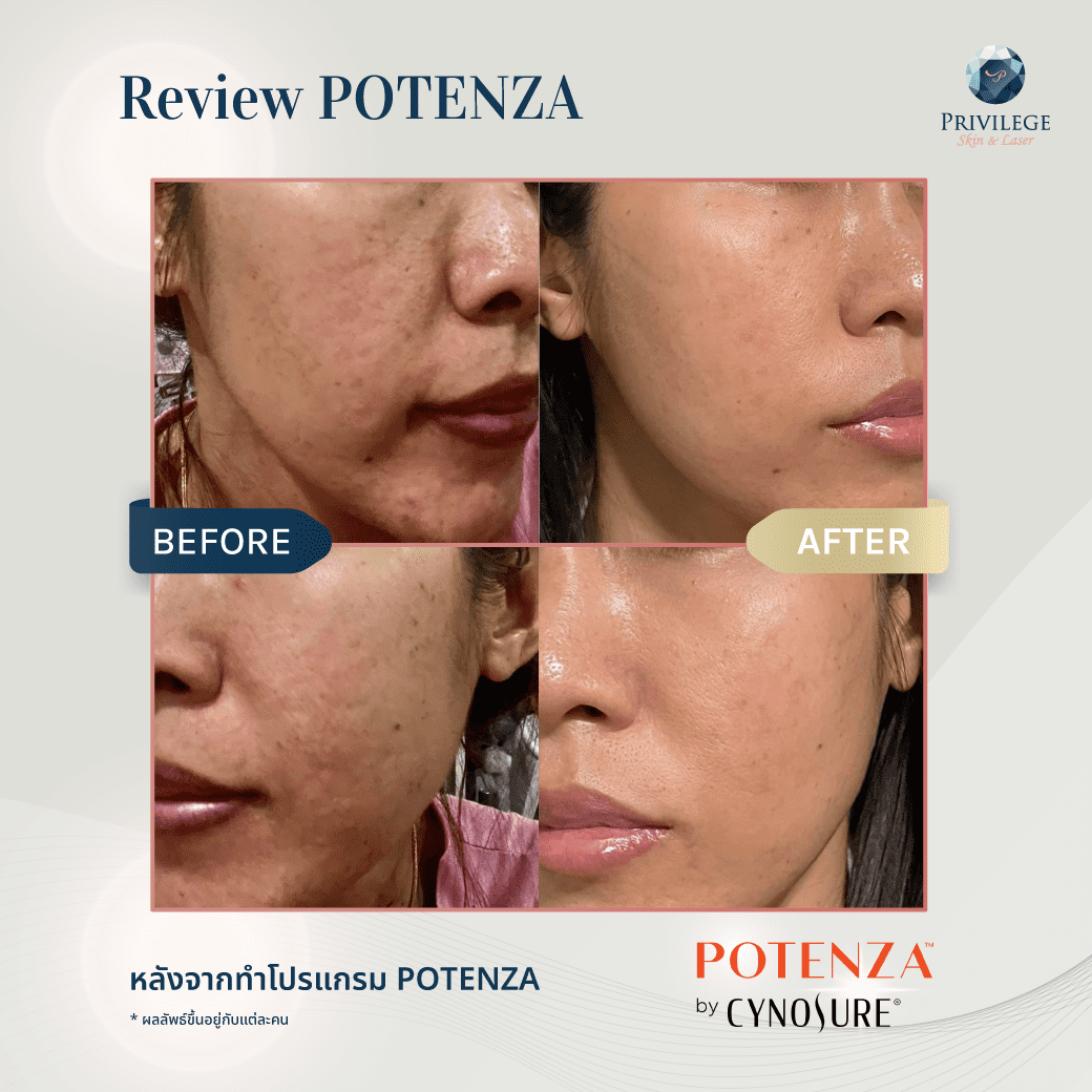 ผิวหย่อนคล้อย ริ้วรอยร่องตื้น หลุมสิว จัดการได้ด้วย POTENZA - Privilege ...