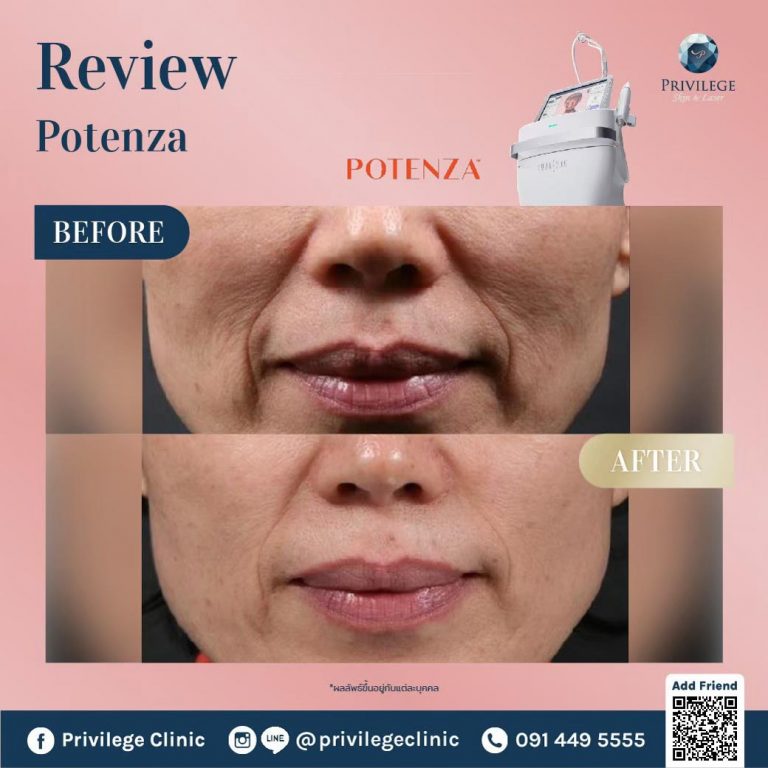 Before After - Privilege Clinic